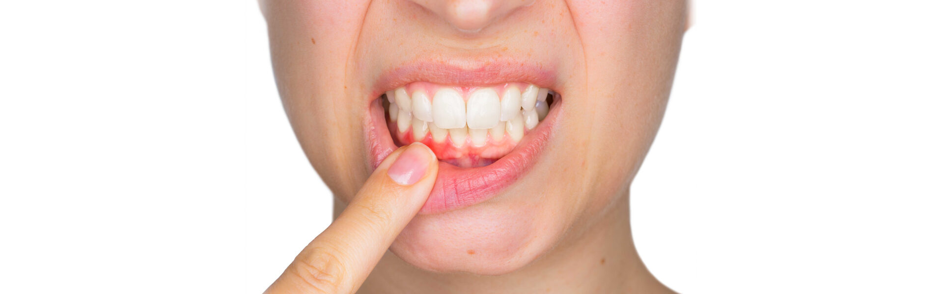 Gum Conditions | Citrus Heights CA | New Vision Dentistry